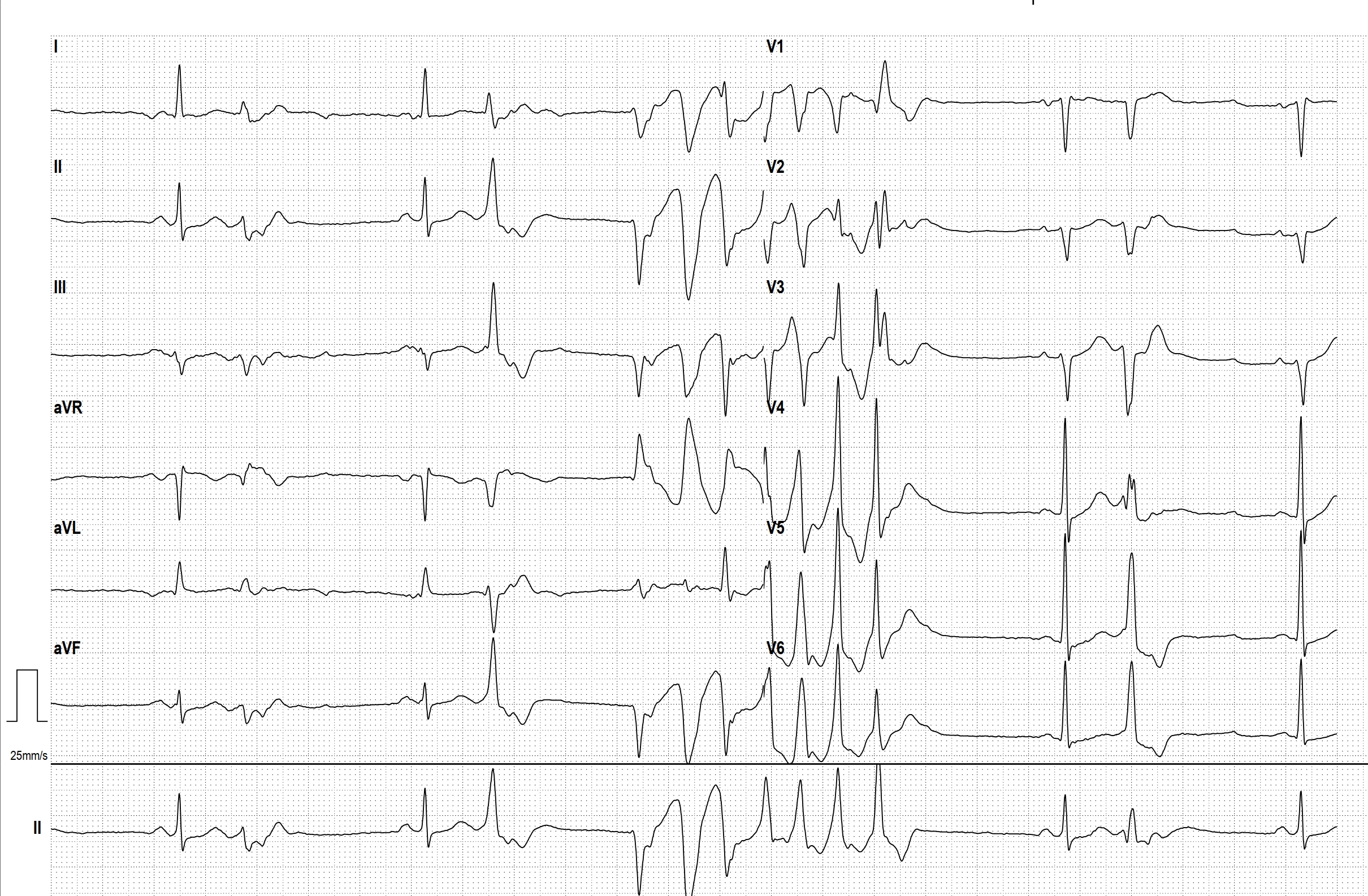 Polymorphic Ventricular Tachycardia Ecg Guru Instructor Resources 8532